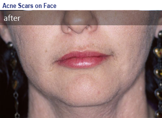 Acne Scars - Dermatology & Laser Institute of Colorado
