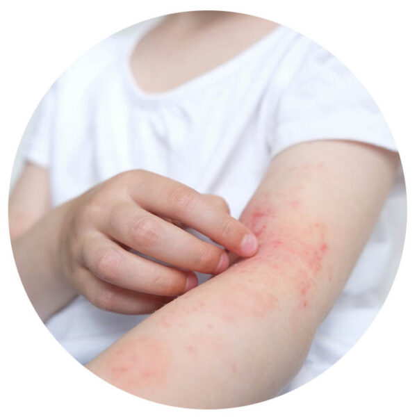 Eczema Dry Skin - Dermatology & Laser Institute of Colorado